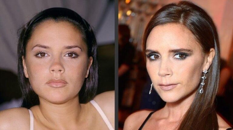 10 famosos con Bichectomia Antes y Después - Dr. Edwin Vásquez